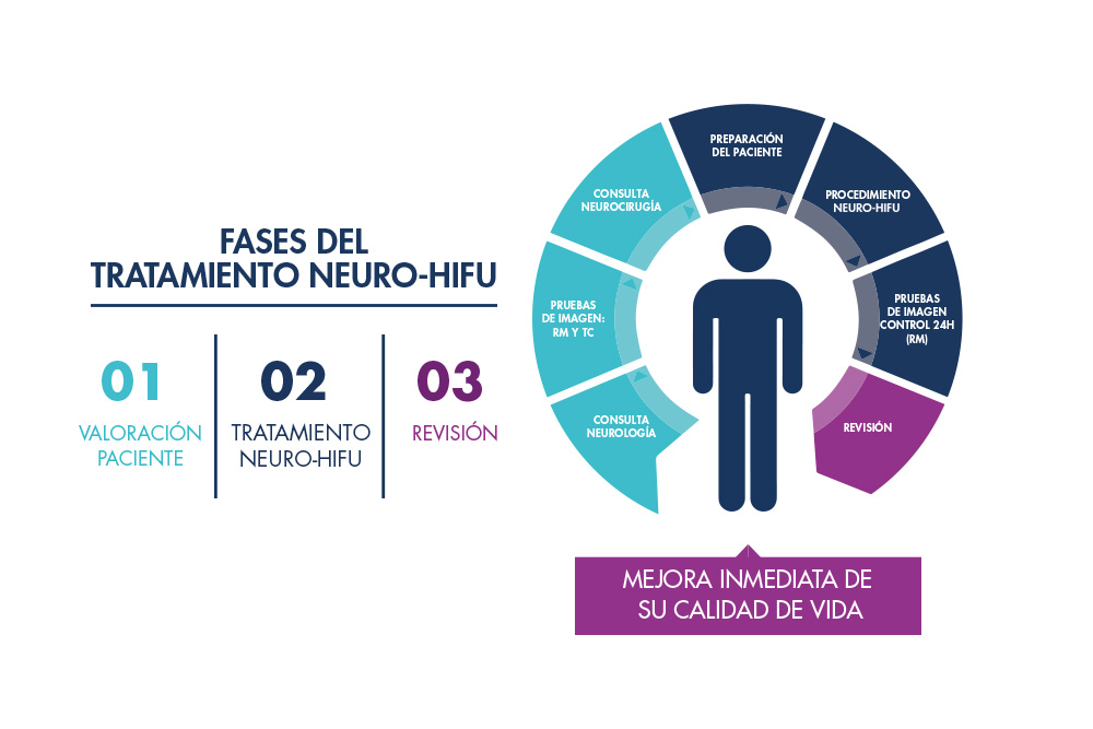 ¿De qué trata la técnica Neuro-HIFU?